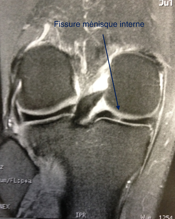 PATHOLOGIE MENISCALE | Chirurgie Orthopédique Sainte Marie