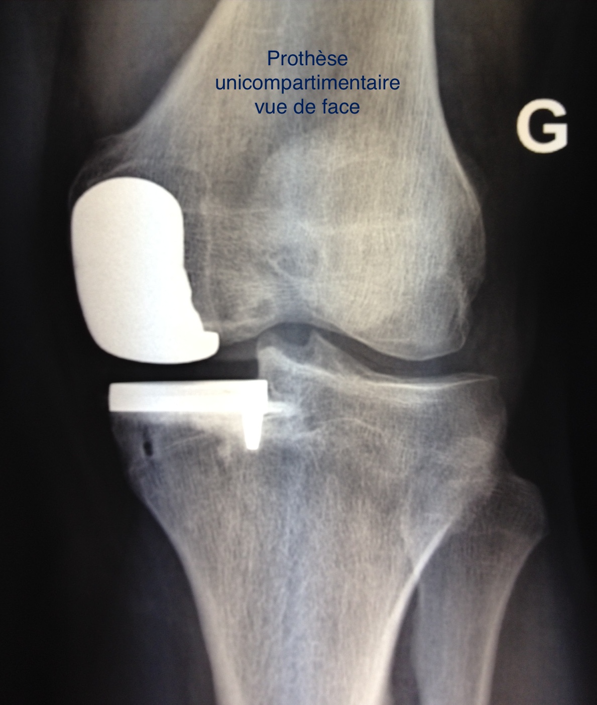 PROTHESE UNICOMPARTIMENTAIRE DU GENOU | Chirurgie Orthopédique Sainte Marie