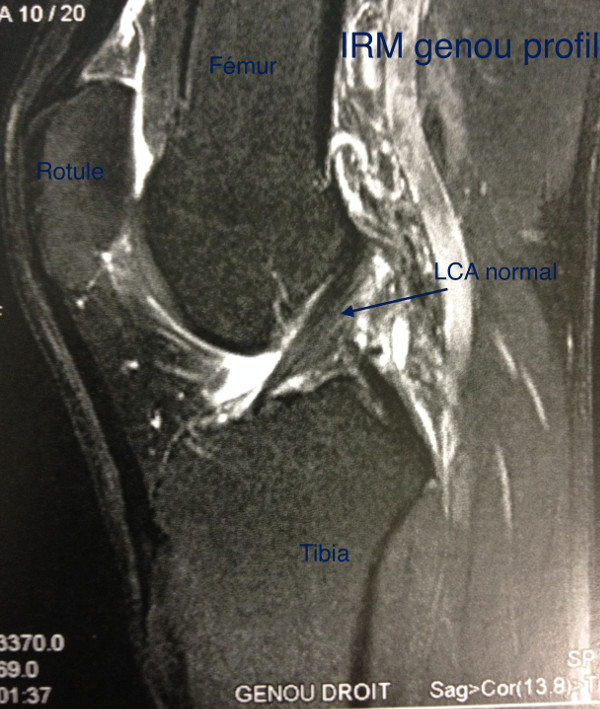 ENTORSE LIGAMENT CROISE ANTERIEUR | Chirurgie Orthopédique Sainte Marie