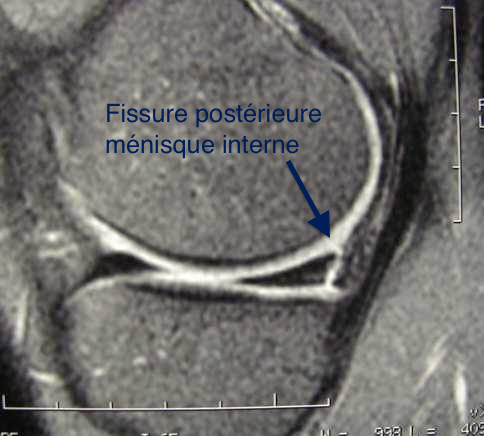 PATHOLOGIE MENISCALE | Chirurgie Orthopédique Sainte Marie